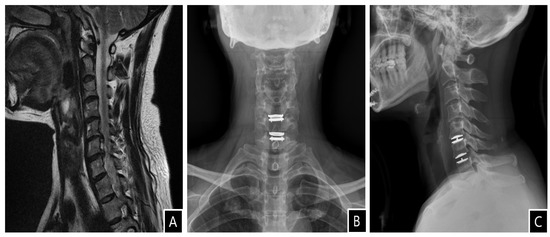 Vertebral Artery Dissection Following Anterior Cervical Decompression ...