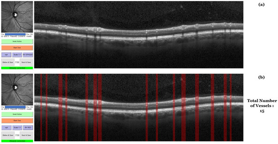 Retinal Blood Vessel Analysis Using Optical Coherence Tomography (OCT ...