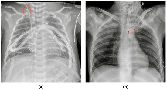 Chest X-ray Interpretation: Detecting Devices and Device-Related ...
