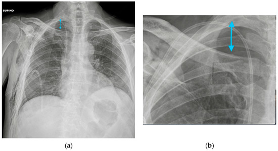 Chest X-ray Interpretation: Detecting Devices and Device-Related ...