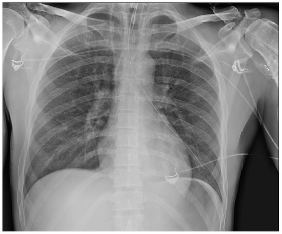 Chest X-ray Interpretation: Detecting Devices and Device-Related ...
