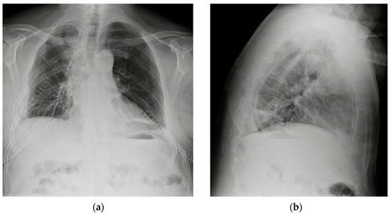 Chest X-ray Interpretation: Detecting Devices and Device-Related ...