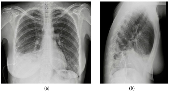 Chest X-ray Interpretation: Detecting Devices and Device-Related ...