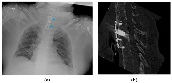 Chest X-ray Interpretation: Detecting Devices and Device-Related ...