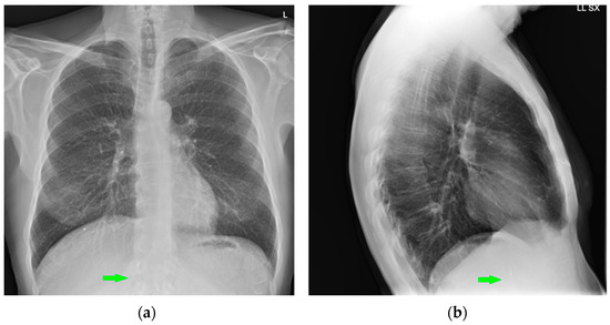 Chest X-ray Interpretation: Detecting Devices and Device-Related ...