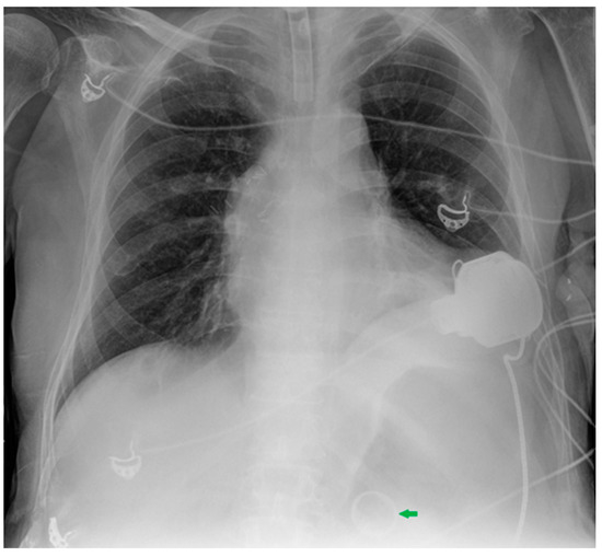Chest Tube X Ray