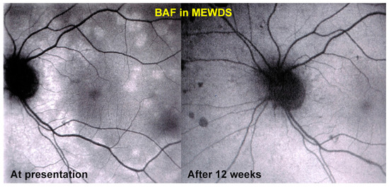 Optical Coherence Tomography Angiography (OCT-A) in Uveitis: A ...