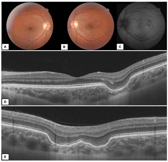 Diagnostics | Free Full-Text | Focal Choroidal Excavation: Epidemiology ...