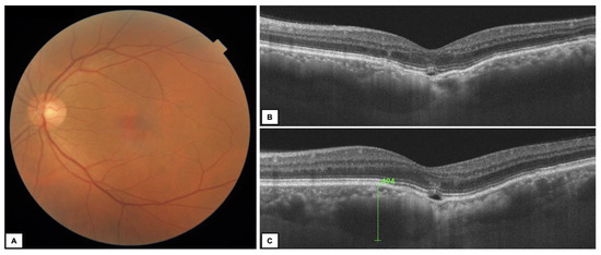Diagnostics | Free Full-Text | Focal Choroidal Excavation: Epidemiology ...