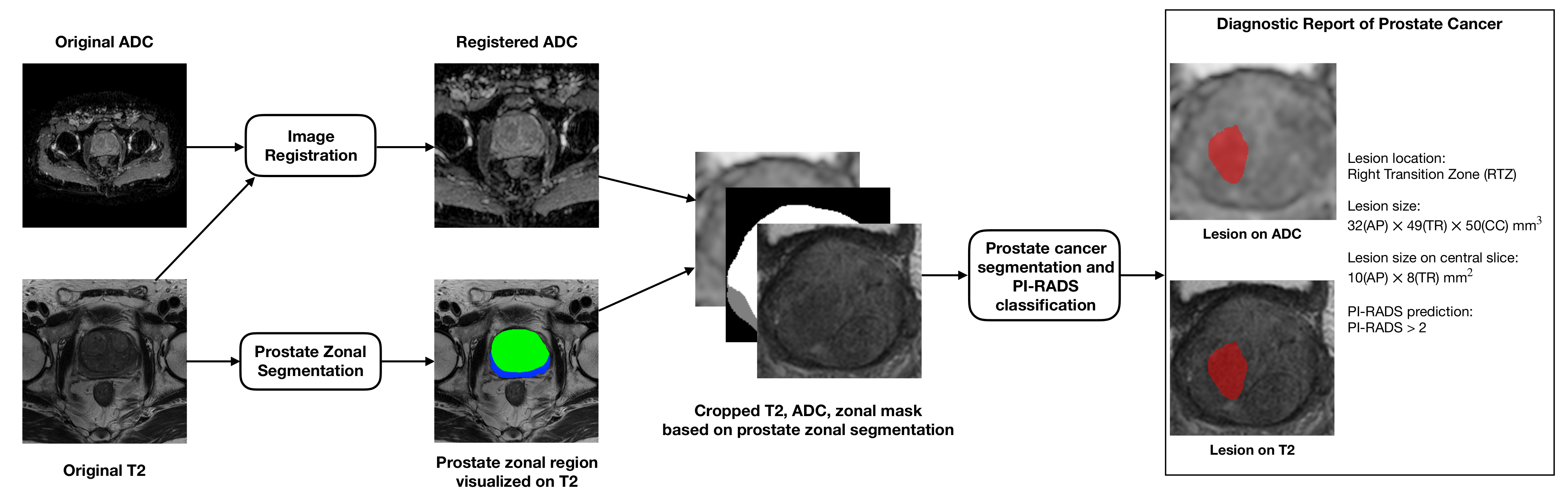 Joint Cancer Segmentation and PI-RADS Classification on Multiparametric ...