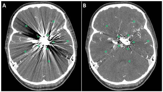 Single-Energy Metal Artifact Reduction (SEMAR) in Ultra-High-Resolution CT Angiography of ...