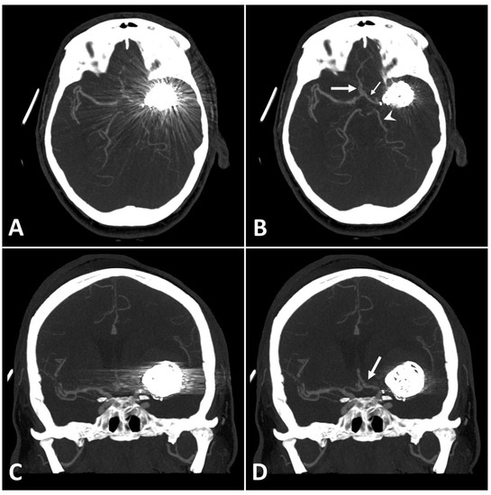 Single-Energy Metal Artifact Reduction (SEMAR) in Ultra-High-Resolution ...