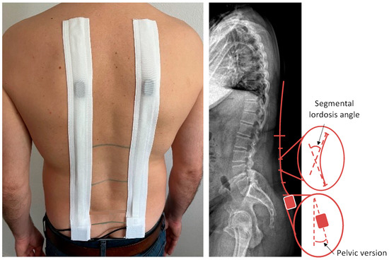 Finger-Floor Distance Is Not a Valid Parameter for the Assessment of ...