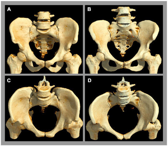 Sex Disparities of the Sacroiliac Joint: Focus on Joint Anatomy and ...