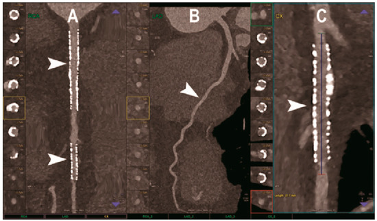 Photon-Counting Computed Tomography (PCCT): Technical Background and ...