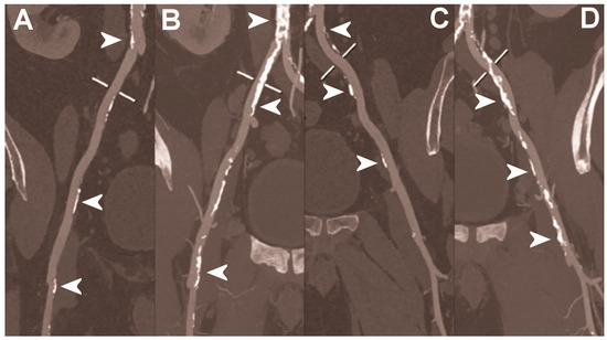 Photon-Counting Computed Tomography (PCCT): Technical Background and ...