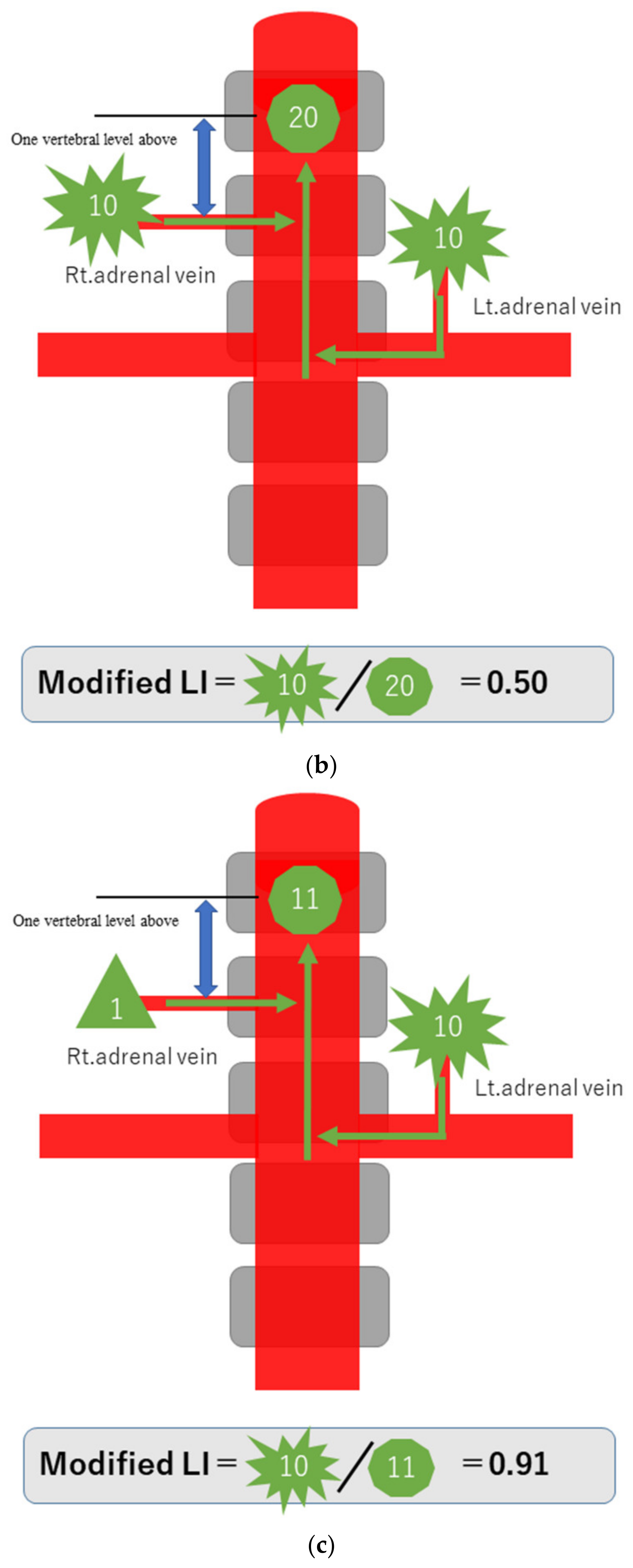 An Ancillary Method for Adrenal Venous Sampling in Cases in Which Right ...