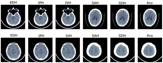 Intracranial Hemorrhage Detection Using Parallel Deep Convolutional ...