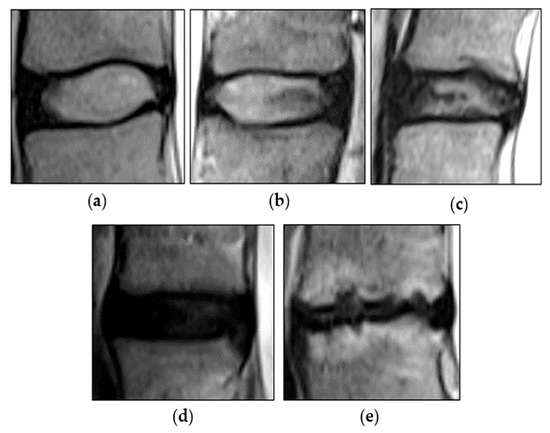 Automatic Detection, Classification, and Grading of Lumbar ...