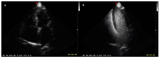 Contrast-Enhanced Ultrasound in Distinguishing between Malignant and ...