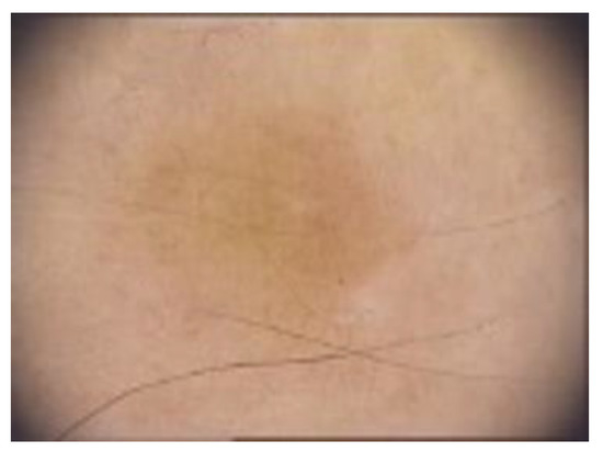 Challenging Patterns of Atypical Dermatofibromas and Promising ...