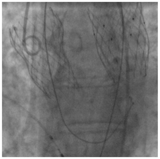 Spectral CT Imaging of Prosthetic Valve Embolization after ...
