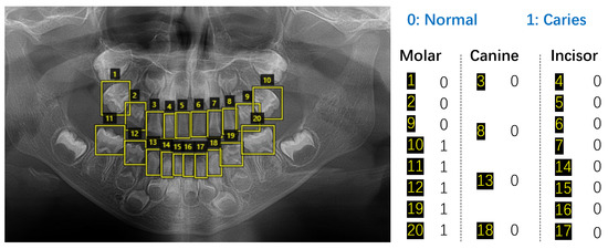 Tooth Type Enhanced Transformer for Children Caries Diagnosis on Dental Panoramic Radiographs