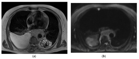 Role of Diffusion-Weighted Magnetic Resonance Imaging for ...