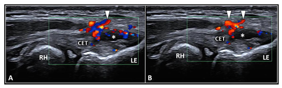Ultrasonography for Injecting (Around) the Lateral Epicondyle: EURO ...