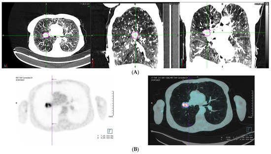 Lung Stereotactic Body Radiation Therapy in a Patient with Severe Lung ...