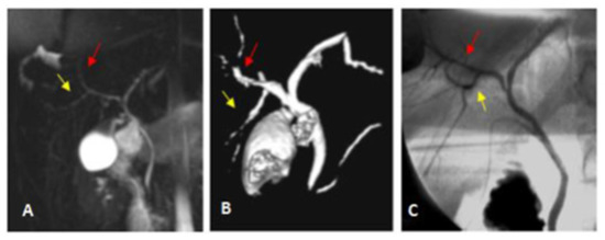 Precision Mapping of Intrahepatic Biliary Anatomy and Its Anatomical ...