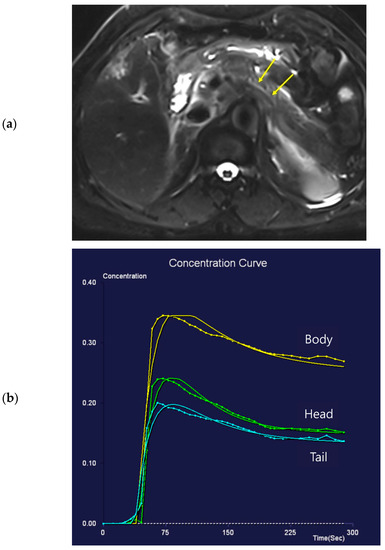 Evaluation of Perfusion Change According to Pancreatic Cancer and Pancreatic Duct Dilatation ...