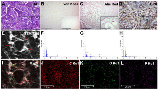 The Prospects of Using Structural Phase Analysis of Microcalcifications ...