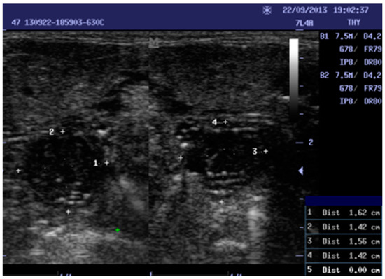 Palatine Tonsil Measurements and Echogenicity during Tonsillitis Using ...