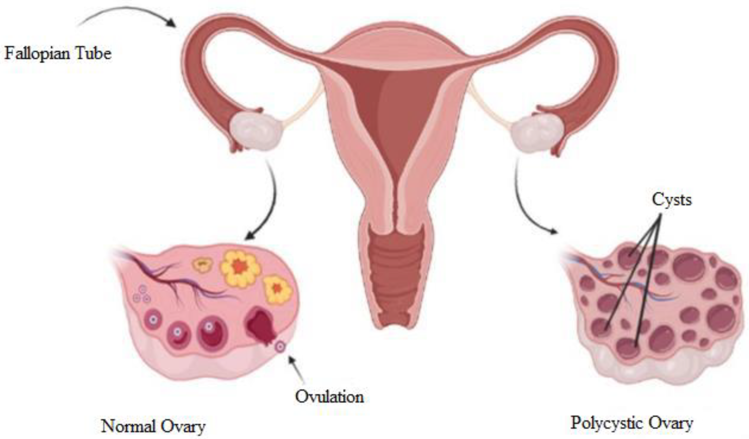 Performance Analysis of a Novel Hybrid Segmentation Method for Polycystic Ovarian Syndrome ...