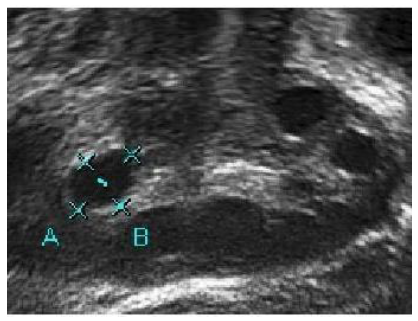 Performance Analysis of a Novel Hybrid Segmentation Method for Polycystic Ovarian Syndrome ...