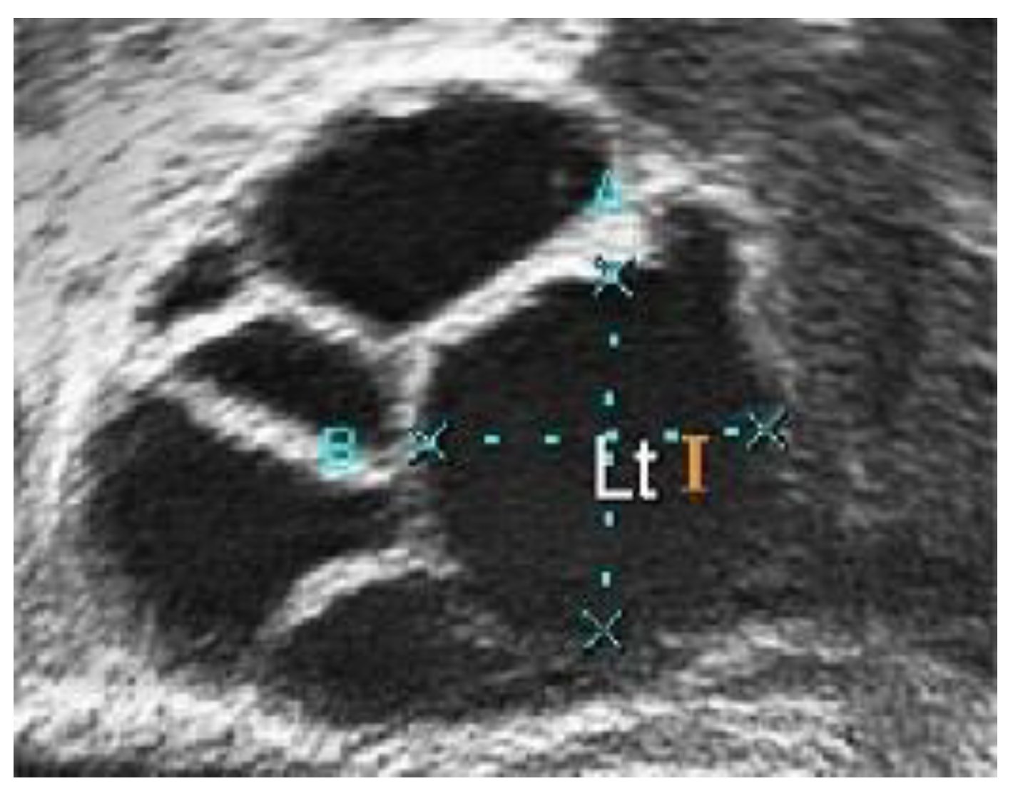 Performance Analysis of a Novel Hybrid Segmentation Method for Polycystic Ovarian Syndrome ...