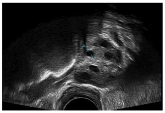 Performance Analysis of a Novel Hybrid Segmentation Method for Polycystic Ovarian Syndrome ...