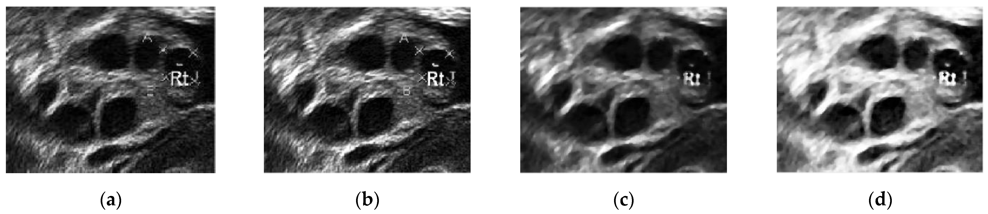 Performance Analysis of a Novel Hybrid Segmentation Method for Polycystic Ovarian Syndrome ...