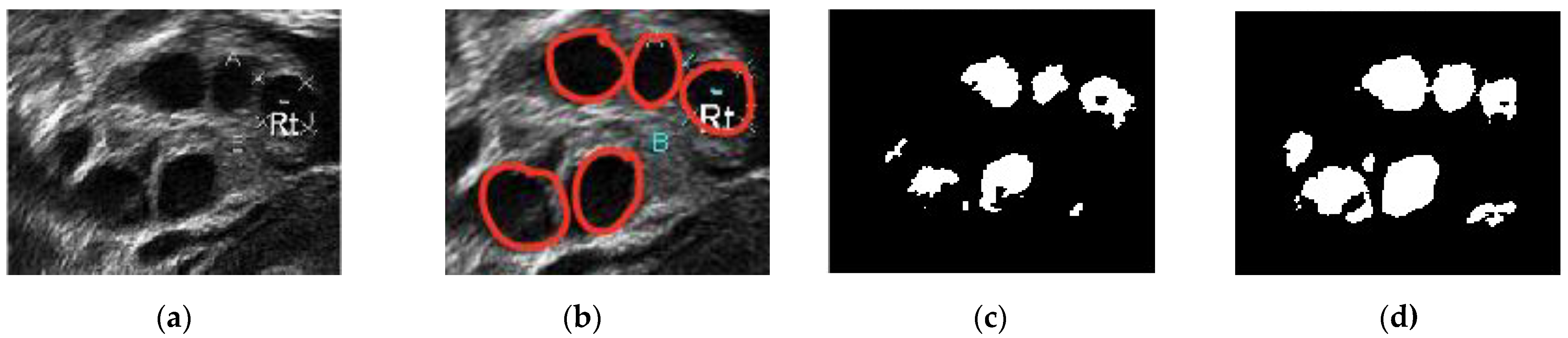 Performance Analysis of a Novel Hybrid Segmentation Method for Polycystic Ovarian Syndrome ...