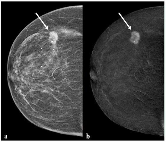 Is the Level of Contrast Enhancement on Contrast-Enhanced Mammography ...