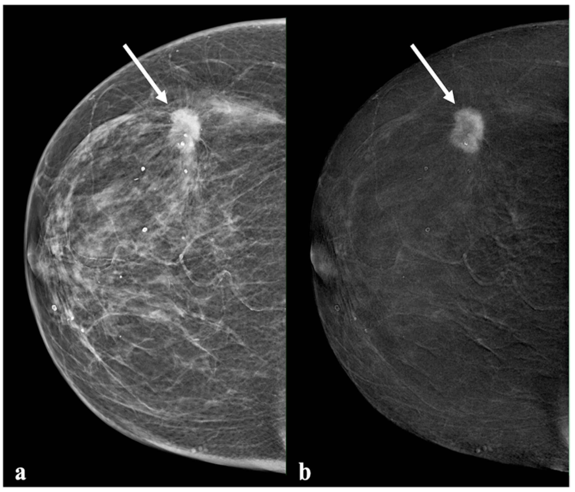 Is the Level of Contrast Enhancement on Contrast-Enhanced Mammography ...