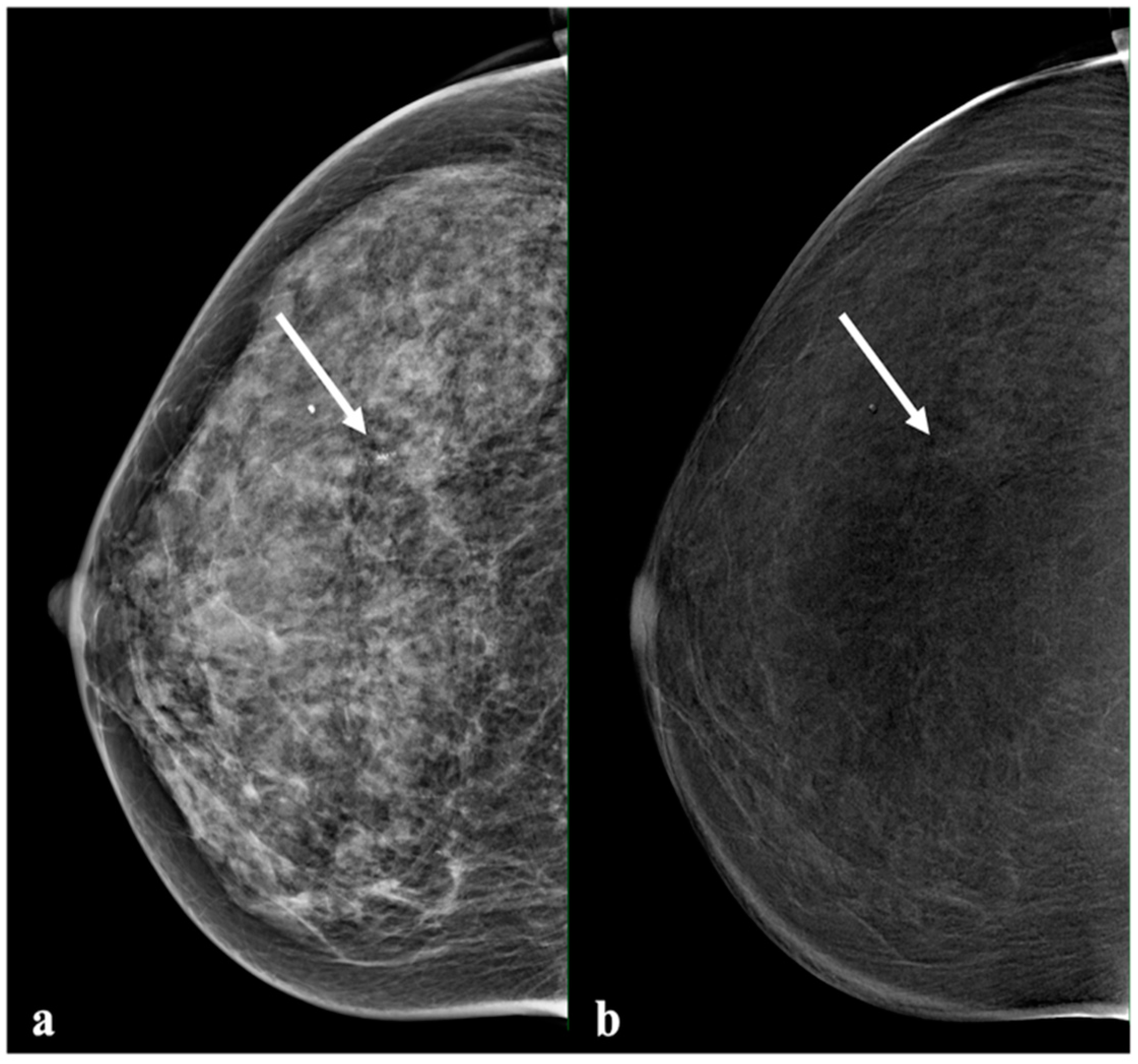 Is the Level of Contrast Enhancement on Contrast-Enhanced Mammography ...