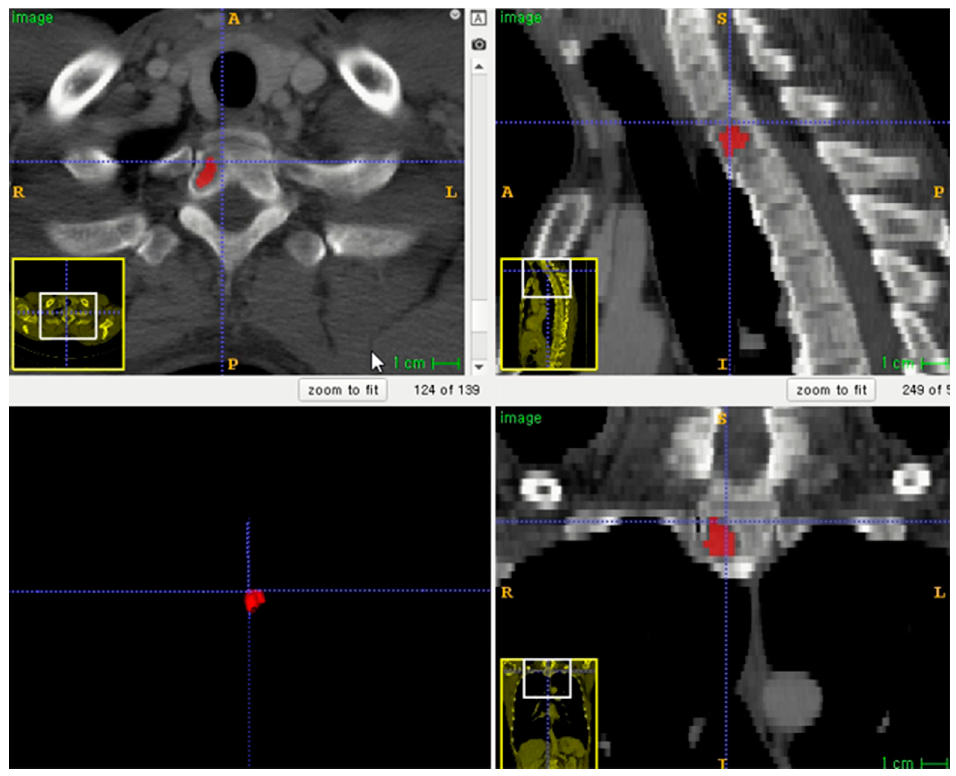 Diagnostics | Free Full-Text | Differentiating Multiple Myeloma and Osteolytic Bone Metastases ...