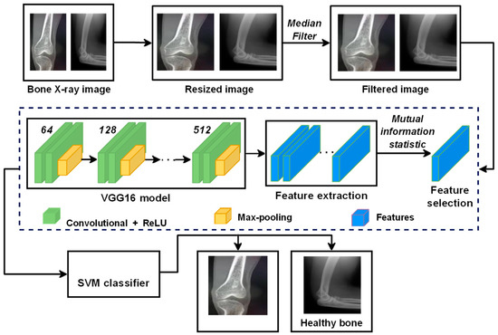 DTBV: A Deep Transfer-Based Bone Cancer Diagnosis System Using VGG16 Feature Extraction