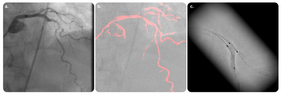 Procedural Software Toolkit in the Armamentarium of Interventional ...