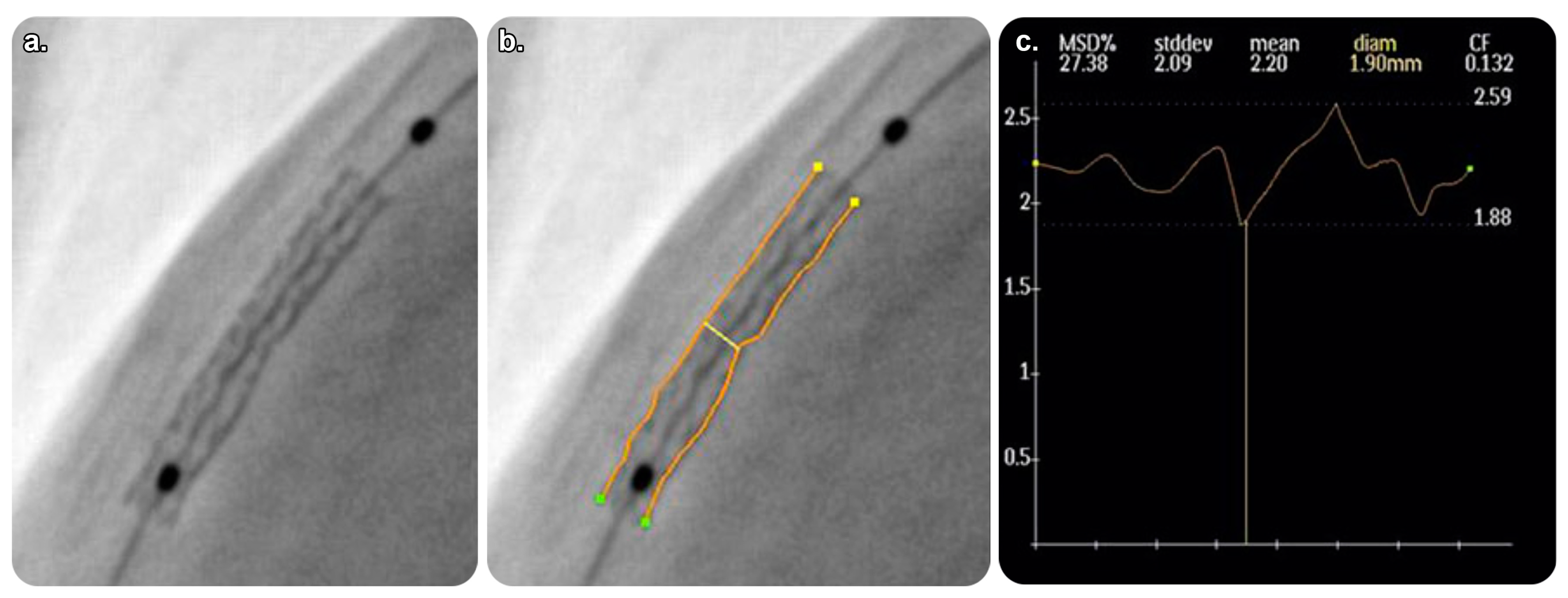 Procedural Software Toolkit in the Armamentarium of Interventional ...
