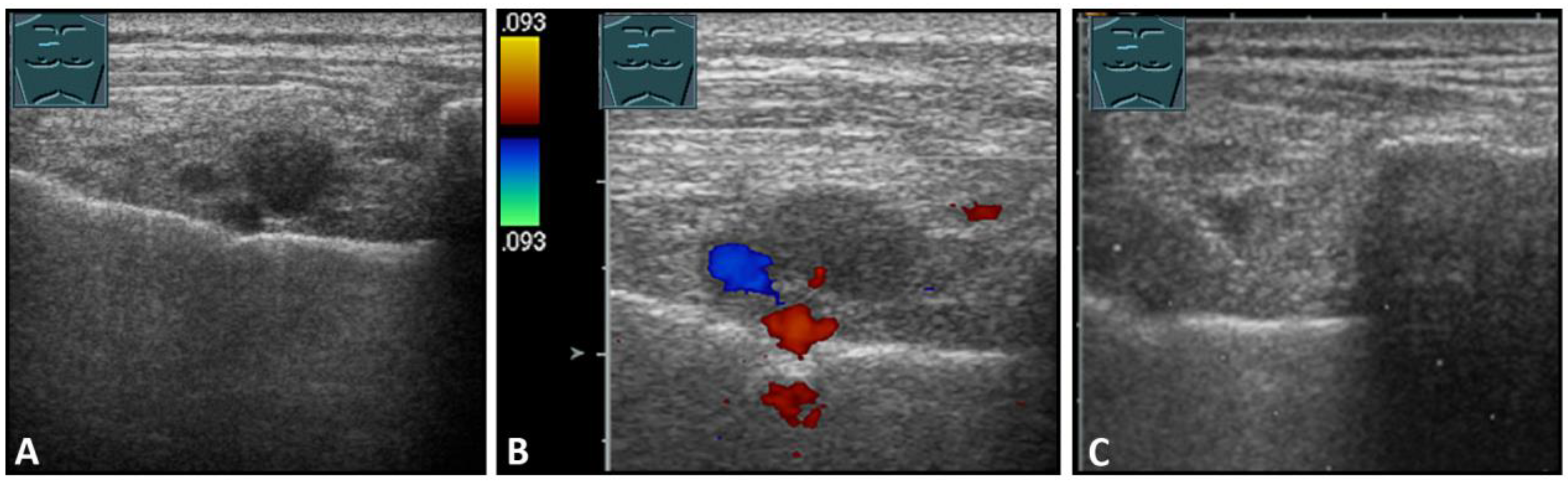 The Role of Thoracic Ultrasound for Diagnosis of Diseases of the Chest ...