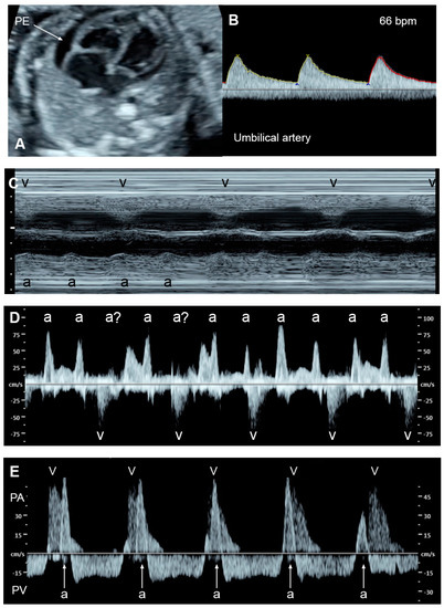 Prenatal Diagnosis of Fetal Heart Failure