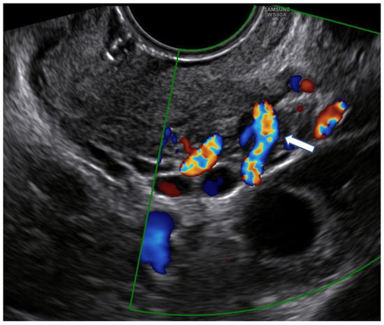 Ultrasound Control of Cervical Regeneration after Large Loop Excision ...